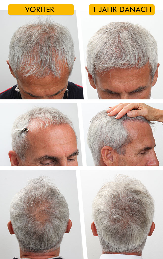 Haartransplantation von Michael Konsel | Moser Medical